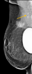 Mastografía por Emisión de Positrones (PEM) – Grupo CT Scanner