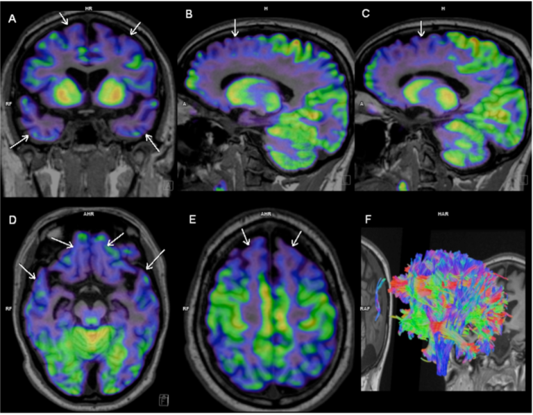 Caso Clínico PET/RM cerebral 2-[18F] FDG – Grupo CT Scanner