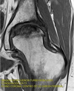 Caso Clínico Necrosis Avascular de Cadera – Grupo CT Scanner