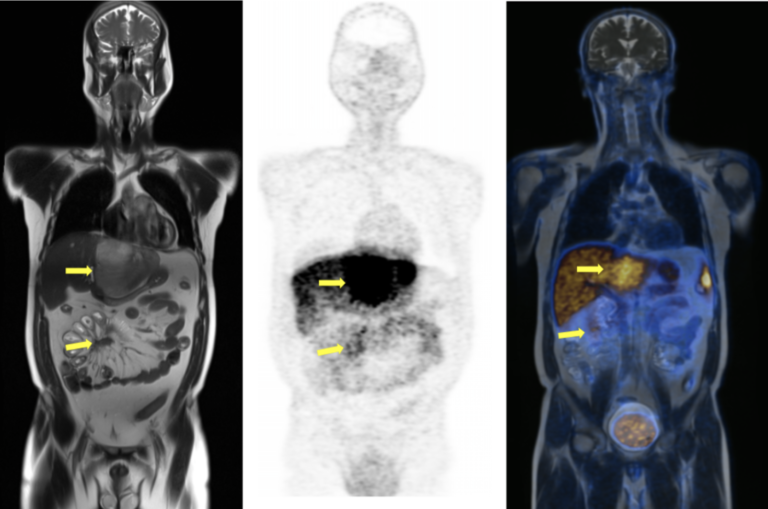 Caso Clínico: Tumor neuroendocrino primario de mesenterio con ...