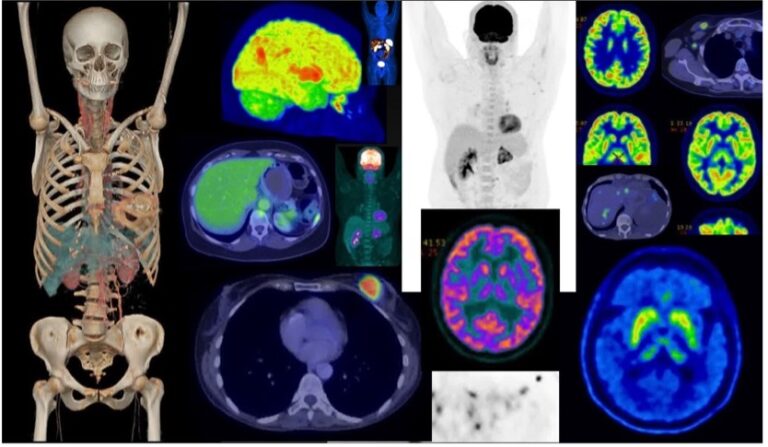 Utilidad del PET/CT Digital – Grupo CT Scanner