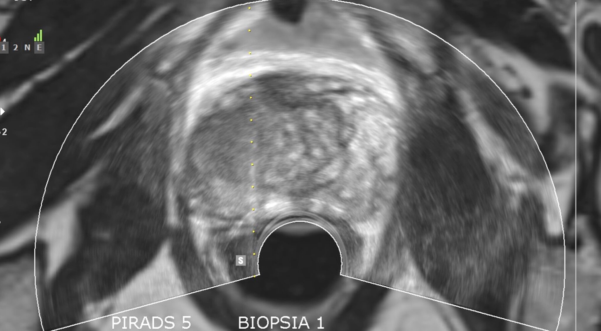 11 de junio, Día mundial del cáncer de próstata – Grupo CT Scanner